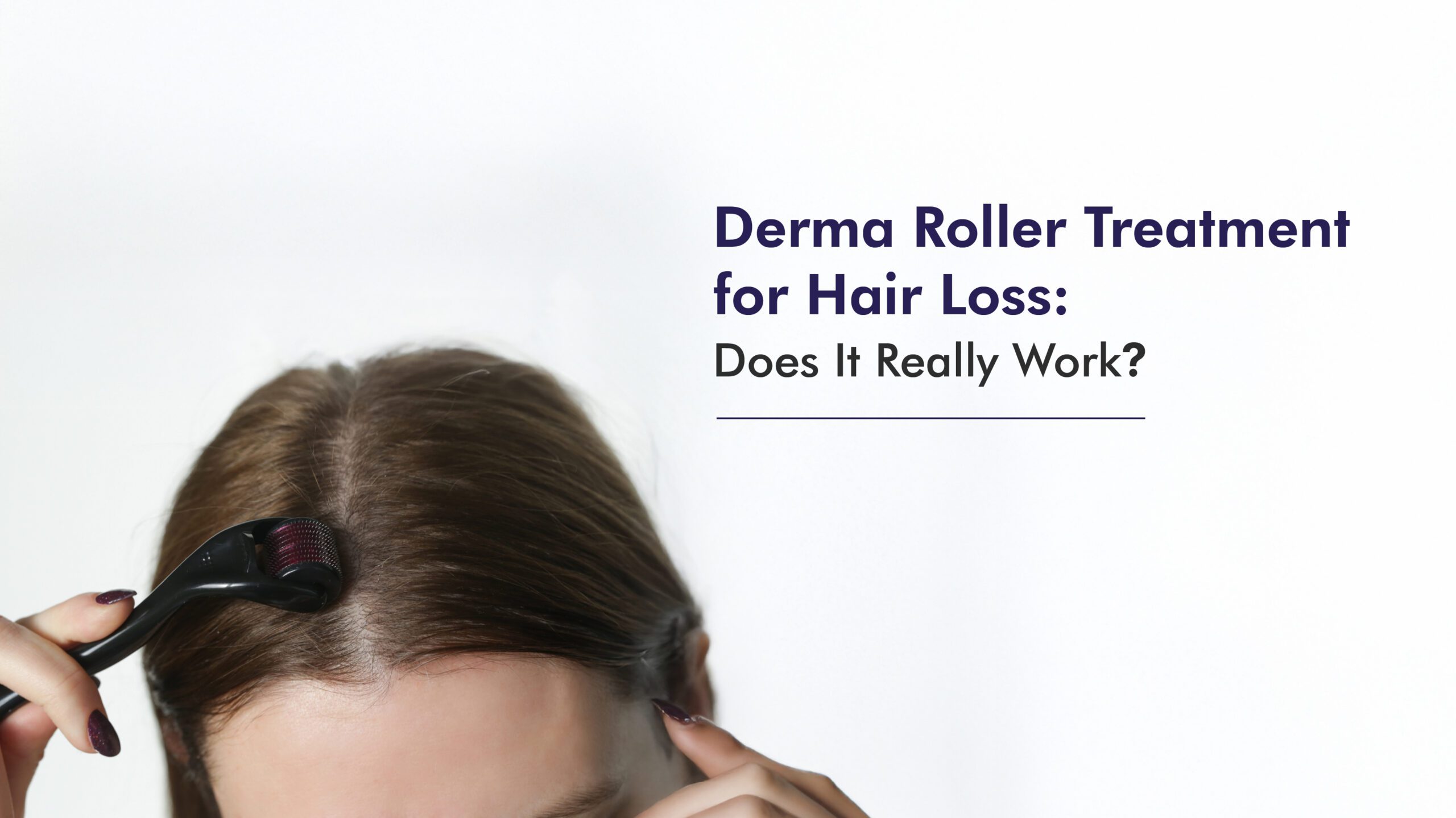 Derma Roller Treatment for Hair Loss: Is It Worth It?