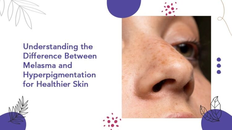 Melasma vs Hyperpigmentation Learn Key Differences and Treatments