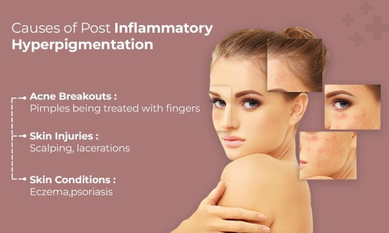 Post Inflammatory Hyperpigmentation Treatment for Clear Skin